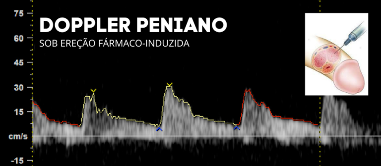 Doppler Peniano com Ereção Fármaco-Induzida